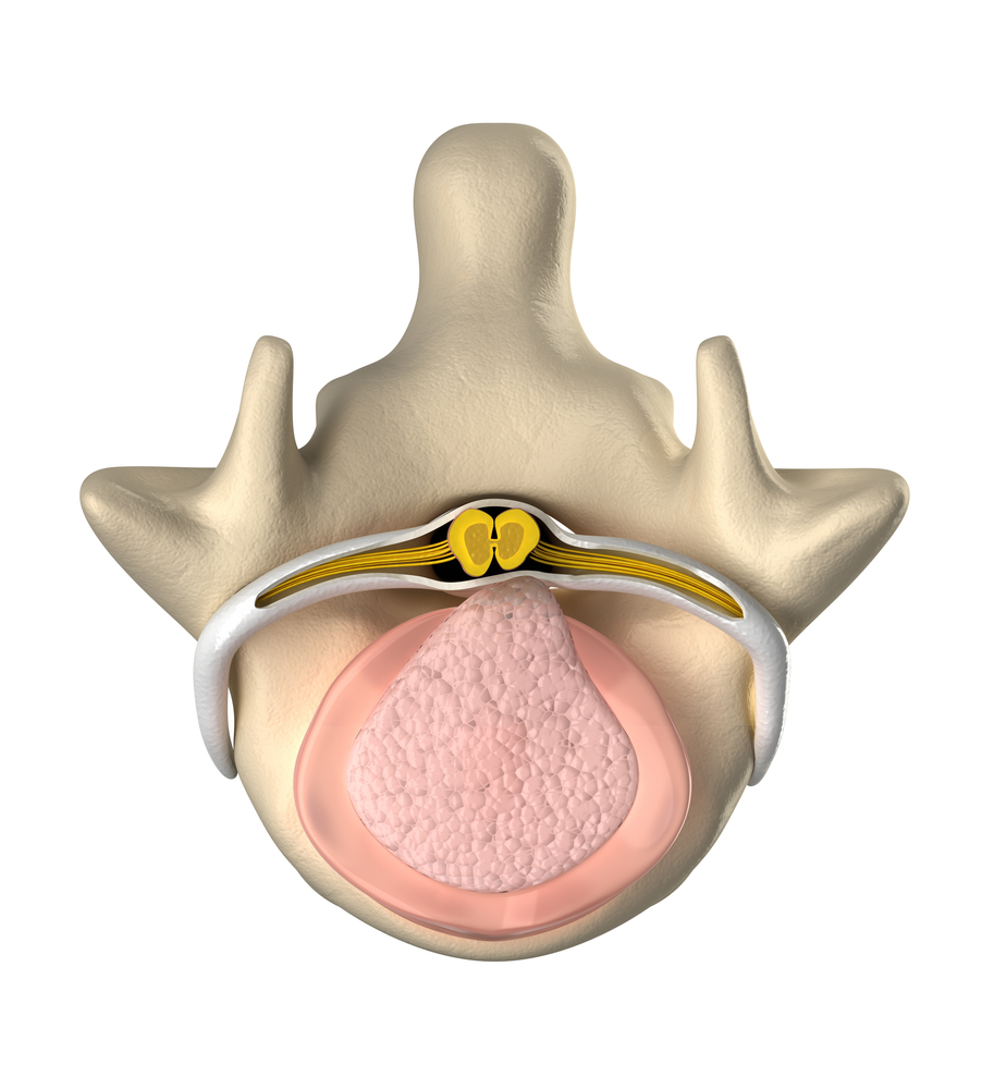 Annular Tear Surgery | Annular Tear Treatment Options