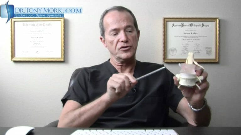 Foraminal Stenosis Treatment | Minimally Invasive Spine Surgery