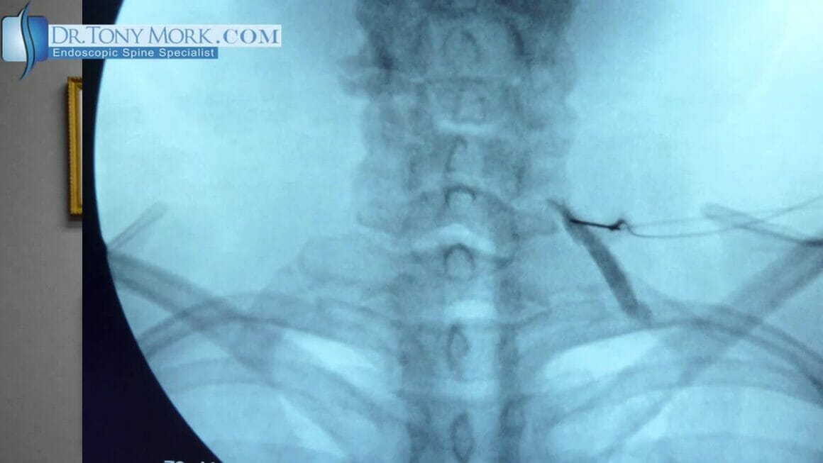 Foraminal Stenosis